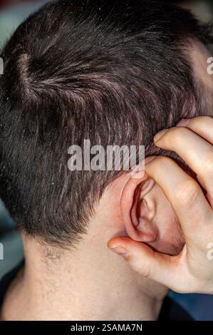 Irritation on the skin behind the ear. Man with flaky skin. Allergy or ...