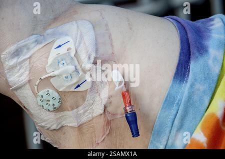A Peripherally Inserted Central Catheter better known as a PICC line Stock Photo - Alamy