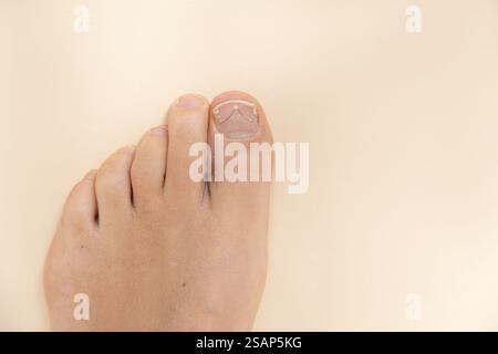 finger with ingrown nail with nail alignment system. Top view, close-up ...