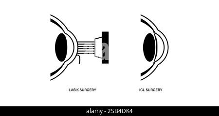 LASIK and EVO ICL eye surgery, illustration Stock Photo - Alamy