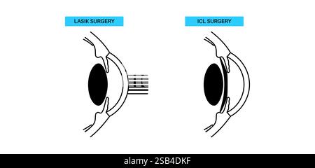 LASIK and EVO ICL eye surgery, illustration Stock Photo - Alamy