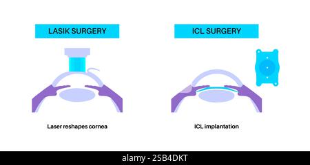 LASIK and EVO ICL eye surgery, illustration Stock Photo - Alamy