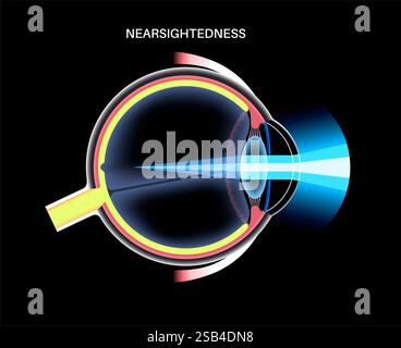 Illustration of an eye with nearsightedness. Nearsightedness is a ...