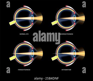 Illustration of refractive errors that impact vision. These errors ...