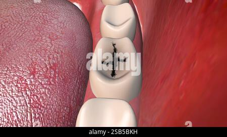 Dental Caries Formation on Molar Tooth Stock Photo - Alamy