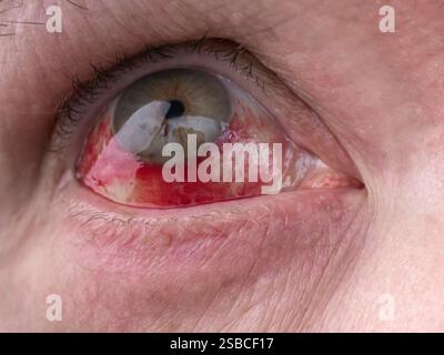 Closeup of irritated red bloodshot eye known as a hyphema ...