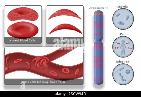 A diagram of Sickle Cell Disease is a recessive genetic disorder ...