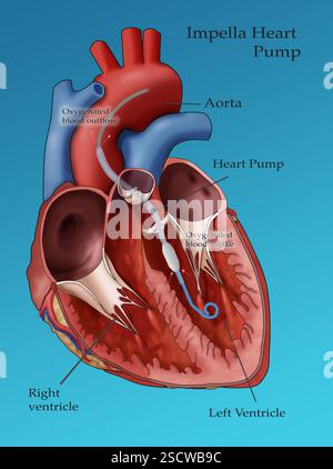 An illustration depicting the placement and positioning of the Impella ...