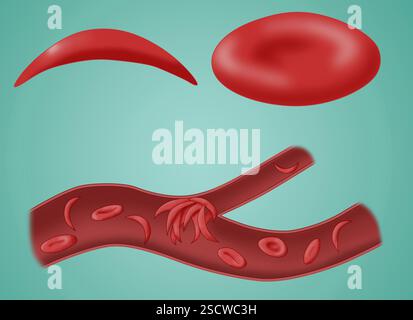 A Normal Blood Cell and a Sickle Cell With a Clogged Artery ...