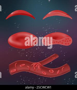 A Normal Blood Cell and a Sickle Cell With a Clogged Artery ...