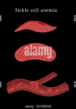 A Normal Blood Cell and a Sickle Cell With a Clogged Artery ...
