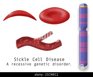 Sickle Cell Disease is a recessive genetic disorder. An illustration ...