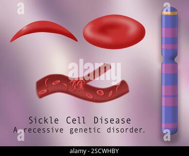 Sickle Cell Disease is a recessive genetic disorder. An illustration ...
