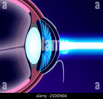 Illustration of laser eye surgery to correct myopia, also known as ...