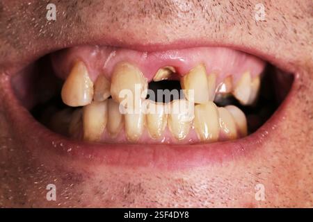 Open mouth with sick, crooked teeth, missing teeth. Dental disease ...