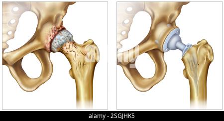 Diagram of osteoarthritis, a degenerative disease that affects the ...