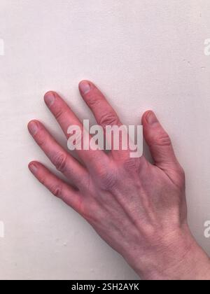 Hand with Raynaud's syndrome Stock Photo - Alamy