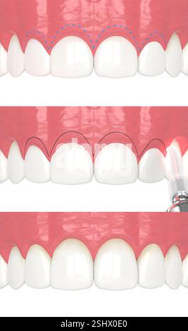 3d render of upper jaw with gummy smile and corrected gum line Stock ...