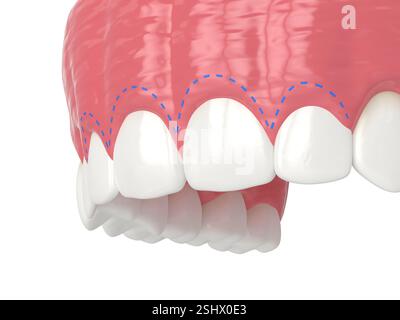 3d render of upper jaw with gummy smile and corrected gum line Stock ...