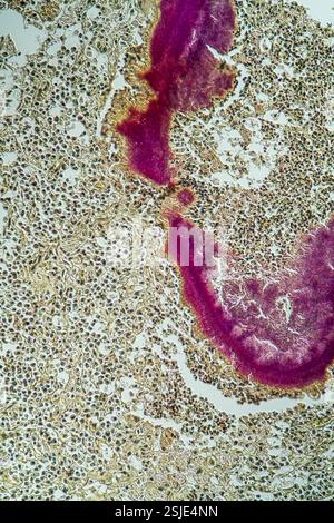 Bacterial disease under the microscope 200x Stock Photo - Alamy