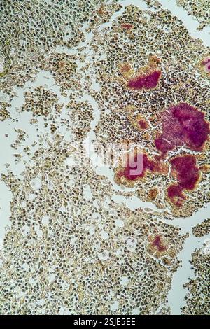 Bacterial disease under the microscope 200x Stock Photo - Alamy