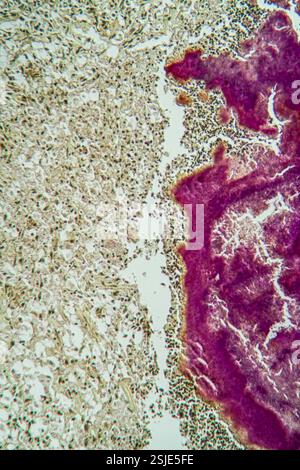 Bacterial disease under the microscope 100x Stock Photo - Alamy
