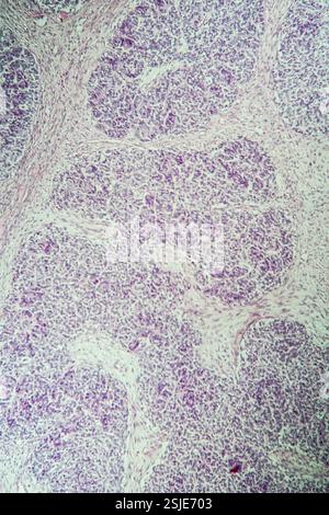 Tumor diseased tissue under the microscope 100x Stock Photo - Alamy