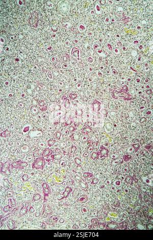 Kidney diseased tissue under the microscope 100x Stock Photo - Alamy