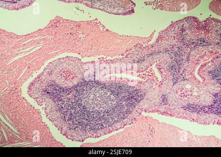 Tumor Diseased tissue under the microscope 100x Stock Photo - Alamy