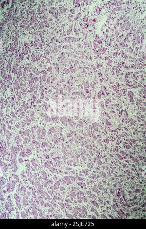 Liver carcinoma diseased tissue under the microscope 100x Stock Photo ...