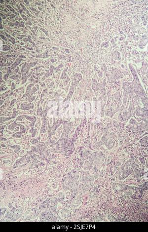 Cancer tissue under the microscope 100x Stock Photo - Alamy