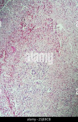 Diseased liver tissue under the microscope 100x Stock Photo - Alamy