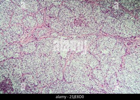 Ovarian diseased tissue under the microscope 100x Stock Photo - Alamy