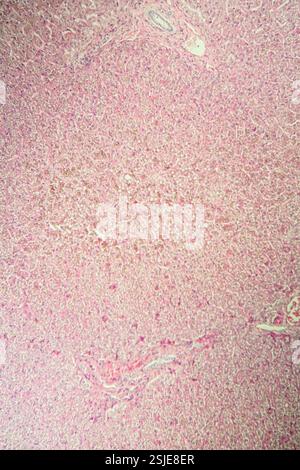 Liver disease under the microscope 100x Stock Photo - Alamy