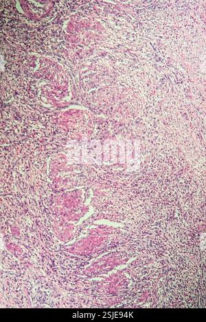 Gallbladder necrosis tissue under the microscope 100x Stock Photo - Alamy
