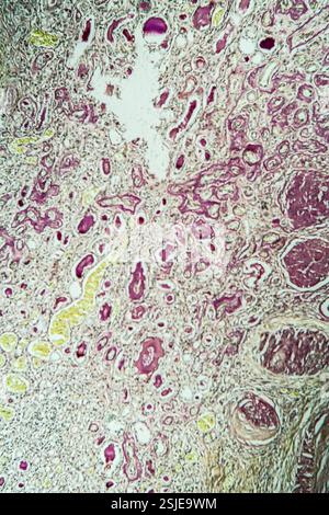 Diseased tissue under the microscope 100x Stock Photo - Alamy