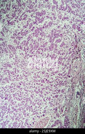 Diseased tissue under the microscope 100x Stock Photo - Alamy