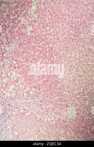 Diseased tissue under the microscope 100x Stock Photo - Alamy