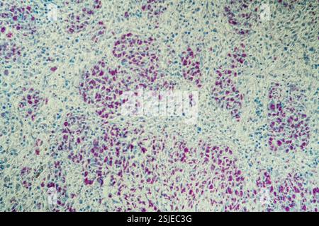 Infected tissue under the microscope 200x Stock Photo - Alamy