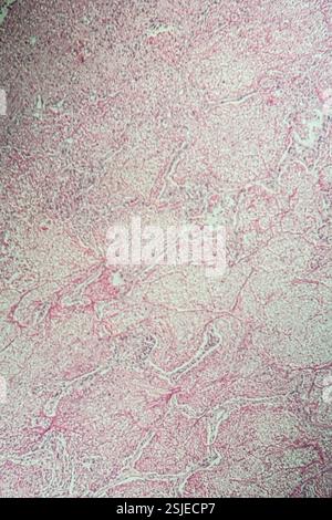 Pneumonia inflamed tissue under the microscope 100x Stock Photo - Alamy