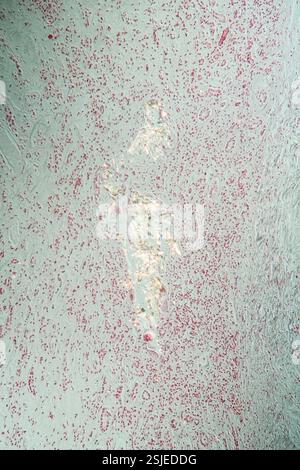 Kidney tissue with gout tissue under microscope 100x Stock Photo - Alamy