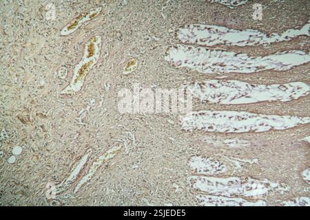 Diverticula in colon tissue under the microscope 100x Stock Photo - Alamy