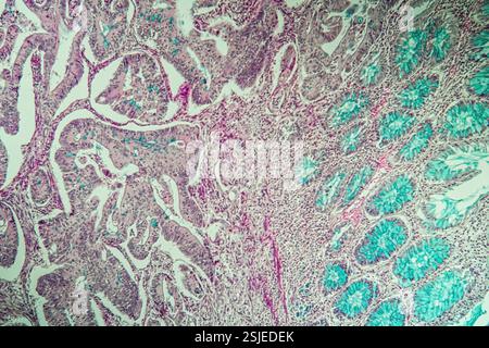 Colon cancer tissue under the microscope 100x Stock Photo - Alamy