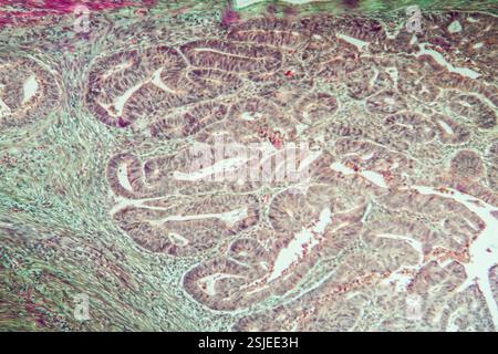 Colon carcinoma Tissue under the microscope 100x Stock Photo - Alamy