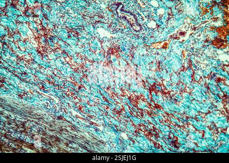 Large intestine diseased tissue 100x Stock Photo - Alamy