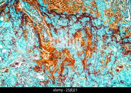 Large intestine diseased tissue 100x Stock Photo - Alamy