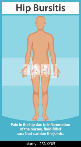 Illustration of hip bursitis and joint inflammation Stock Vector Image ...