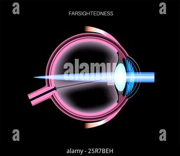 Illustration of farsightedness. Farsightedness, or hyperopia, is a ...