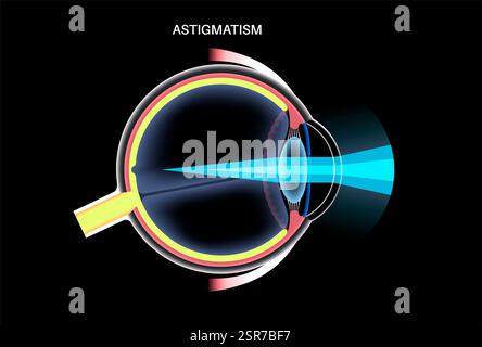 Illustration of the astigmatism eye condition. Astigmatism is an ...