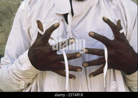 Hand with six fingers, india Stock Photo - Alamy